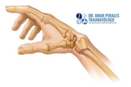 fractura de radio distal – Dr. Omar Perales